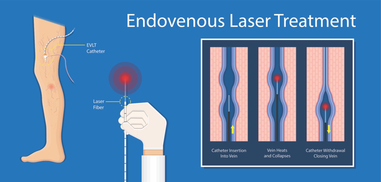 Varicose Veins Treatment in Pune | Dr. Kaurabhi Zade